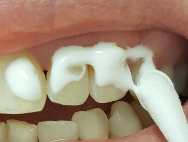 GC Tooth Mousse Review and Advice for Use – Dental Revelations